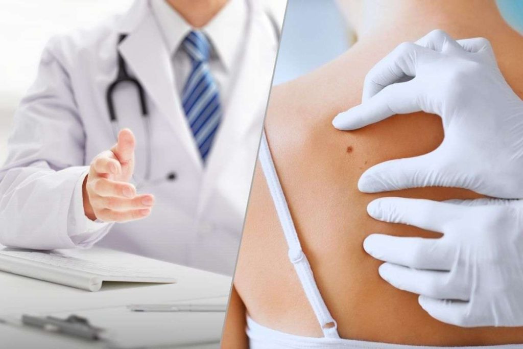 Proteggere la pelle, ecco come accorgersi se un neo é potenzialmente ...